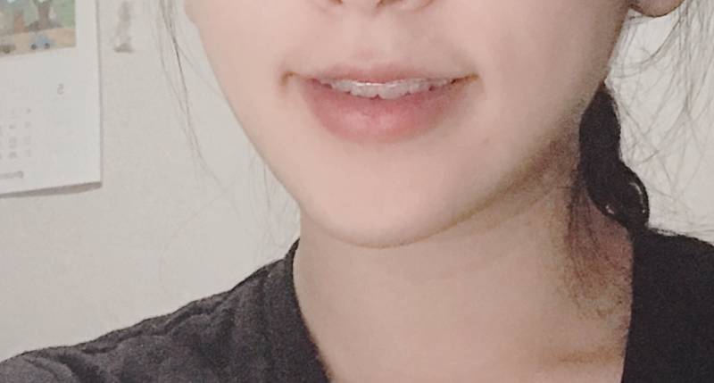 인중 색소침착?? 어떻게 없애 진짜ㅜㅠㅠㅠ4040 - 인스티즈(instiz) 일상 카테고리