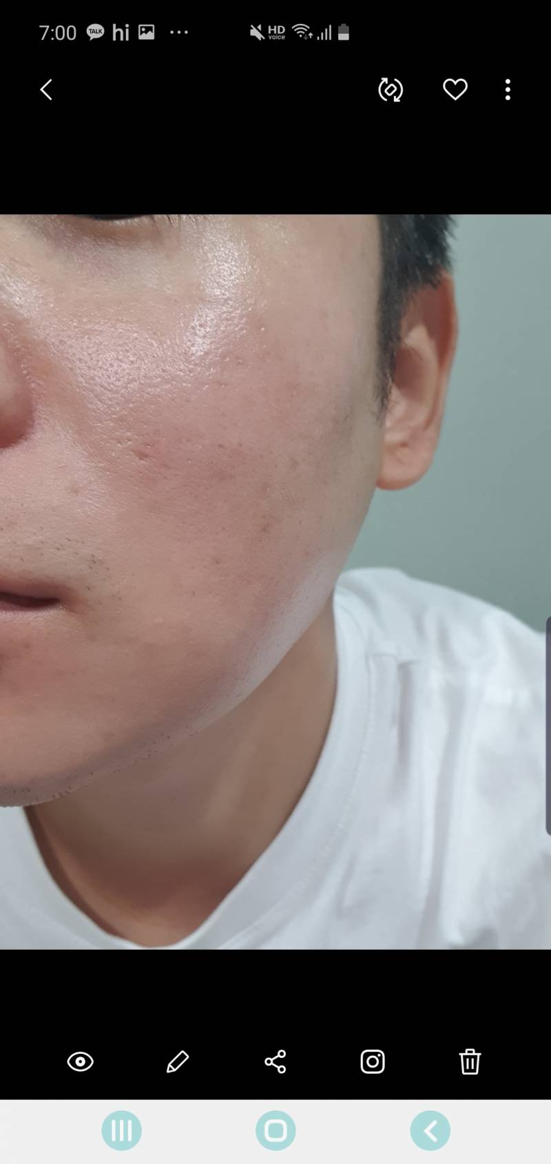 Tca용액100프로하고 흉터생김... - 인스티즈(instiz) 뷰티 카테고리