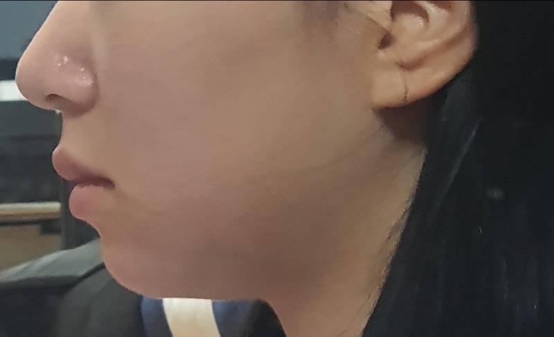 무턱인지 아닌지 봐주라ㅠㅠ4040 - 인스티즈(instiz) 뷰티 카테고리