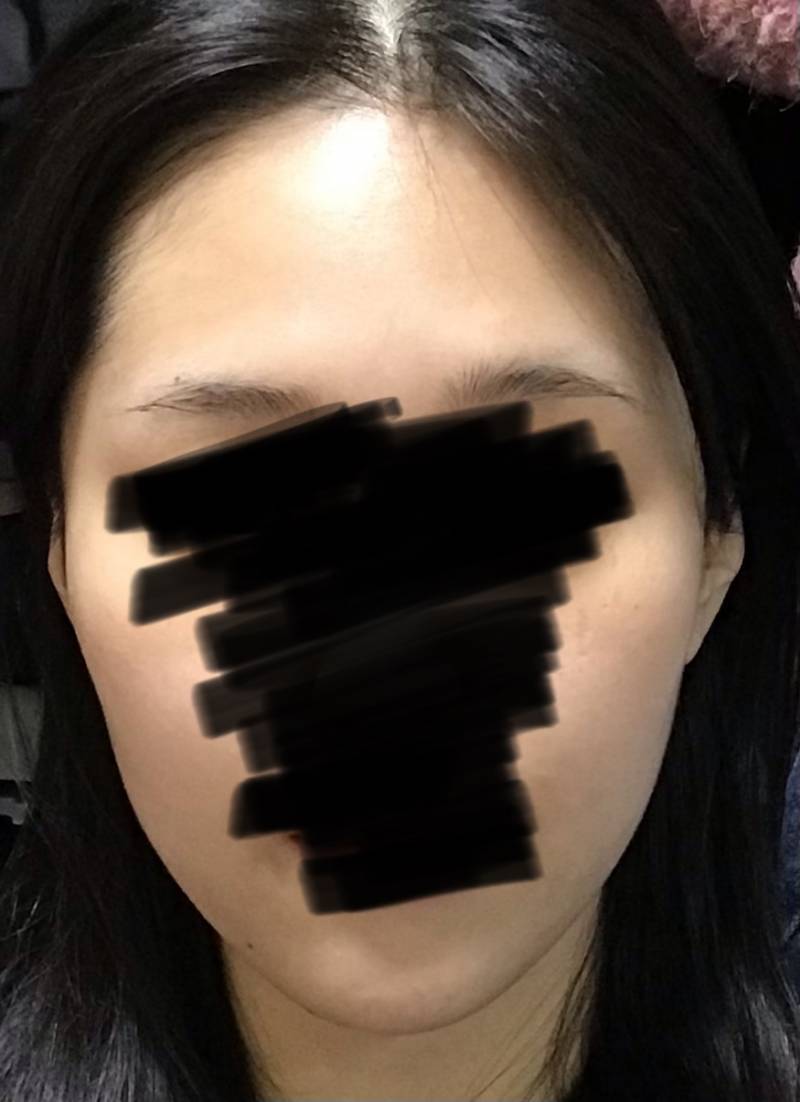 너네라면 광대수술 해? - 인스티즈(instiz) 뷰티 카테고리