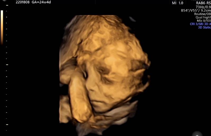 [잡담] 울 아가 3D 초음파 볼 사람?? - 인스티즈(instiz) 일상 카테고리