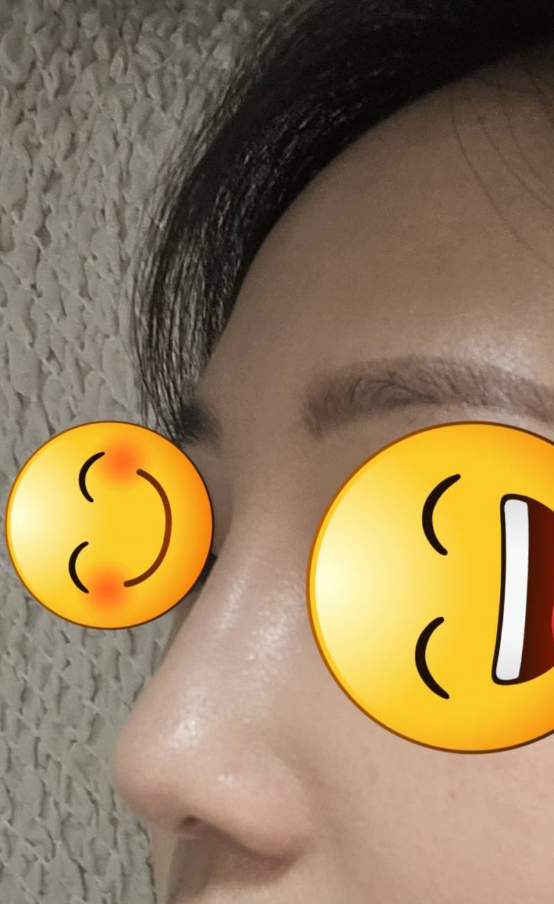 [잡담] 코 수술 하고 싶은데(4040) - 인스티즈(instiz) 뷰티 카테고리