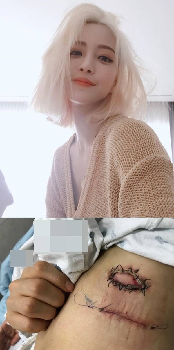 배우 한예슬 "지방종 제거 수술 받다 의료사고 당했다" - 기사 사진이 혐일수 있습니다 (MBN) - 인스티즈(instiz) 이슈 카테고리