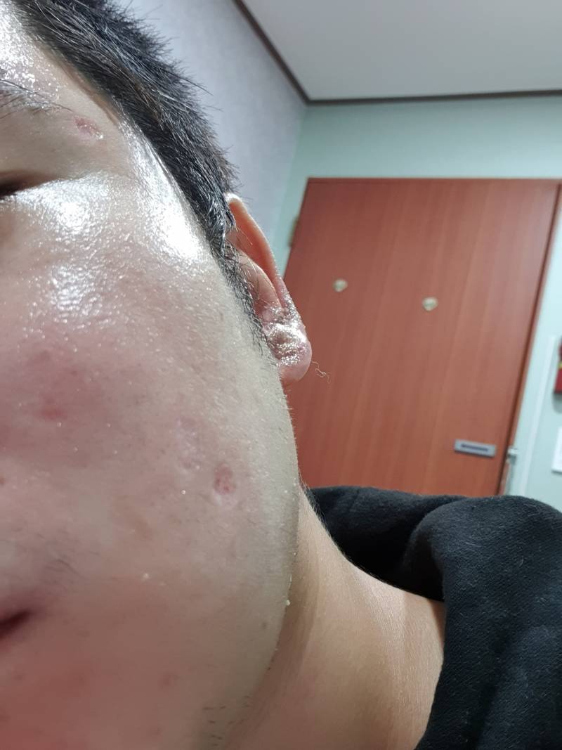 Tca용액100프로하고 흉터생김... - 인스티즈(instiz) 뷰티 카테고리